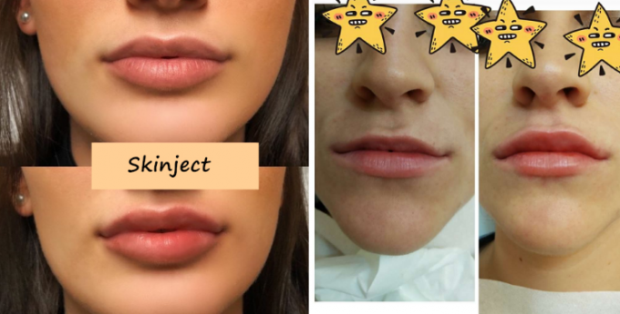 MSDS OEM 5ml Deep Hyaluron Lip Filler Injection