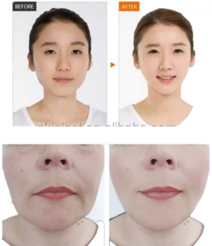 MSDS OEM 5ml Deep Hyaluron Lip Filler Injection