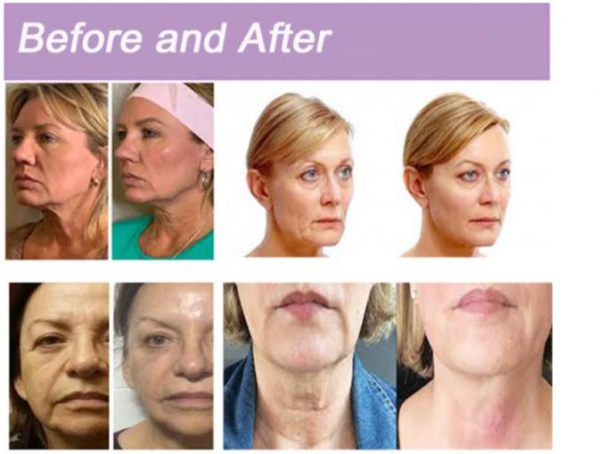 Facial Lifting Mono Screw Threads