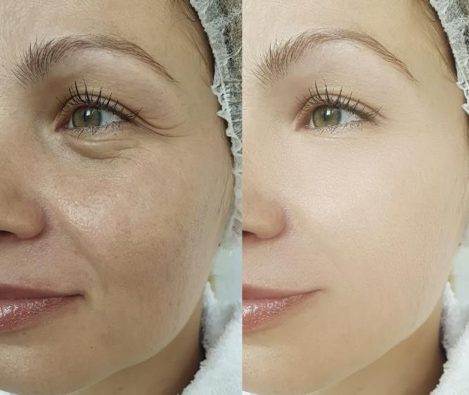 Face Pdrn Serum Skin Whitening Injection For Hyaluron Pen Microneedles