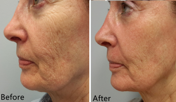 PLLA Facial Lifting Injection 150mg/ml
