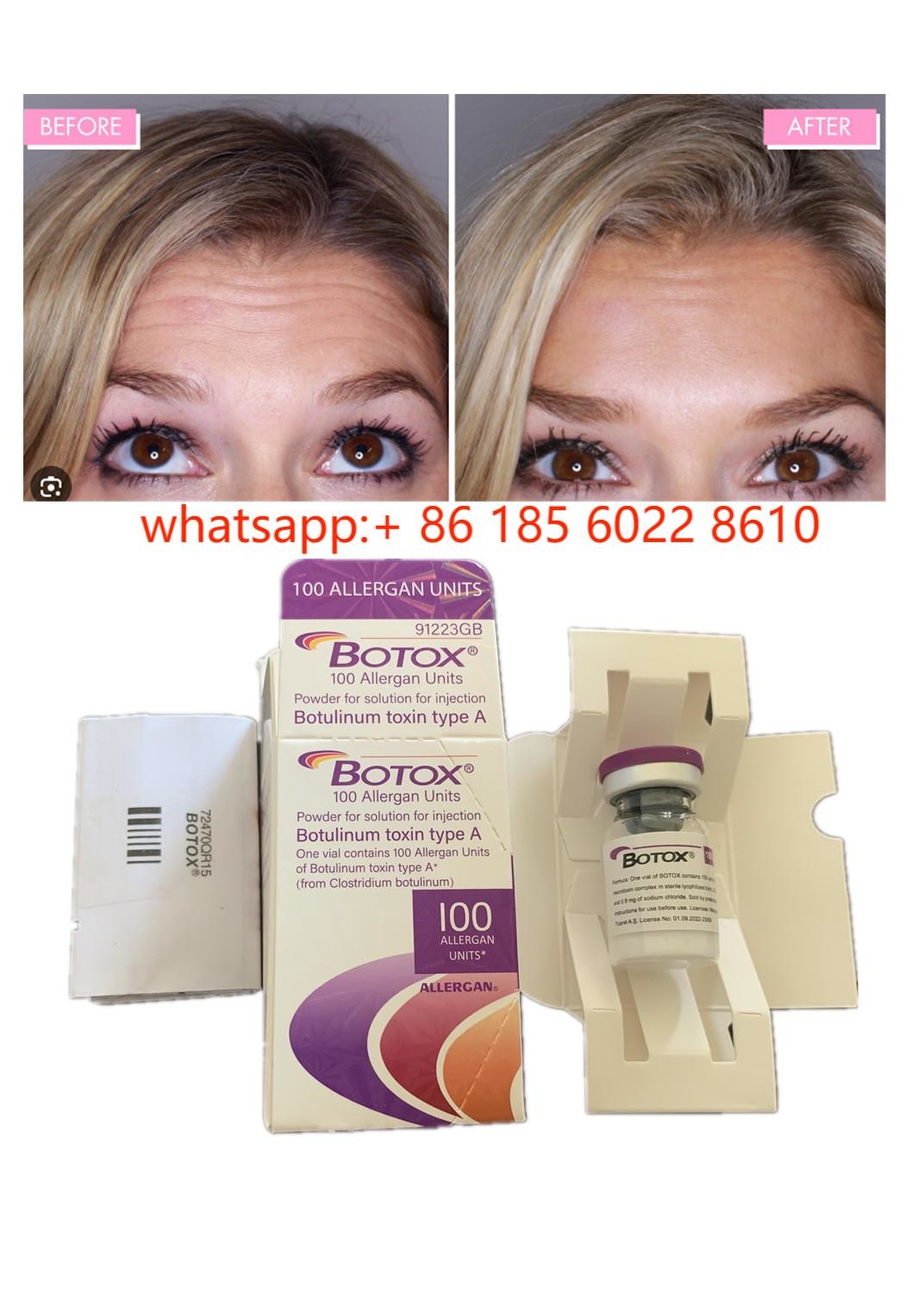 Allergan Botulinum Toxin 100IU Anti-Wrinkles