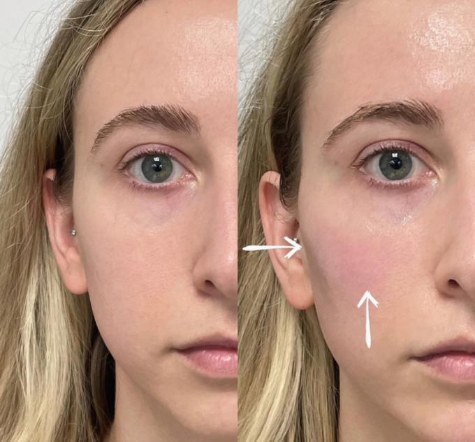 Skinject Deep Hyaluronic Acid Dermal 2ml Lips Fillers Injectable